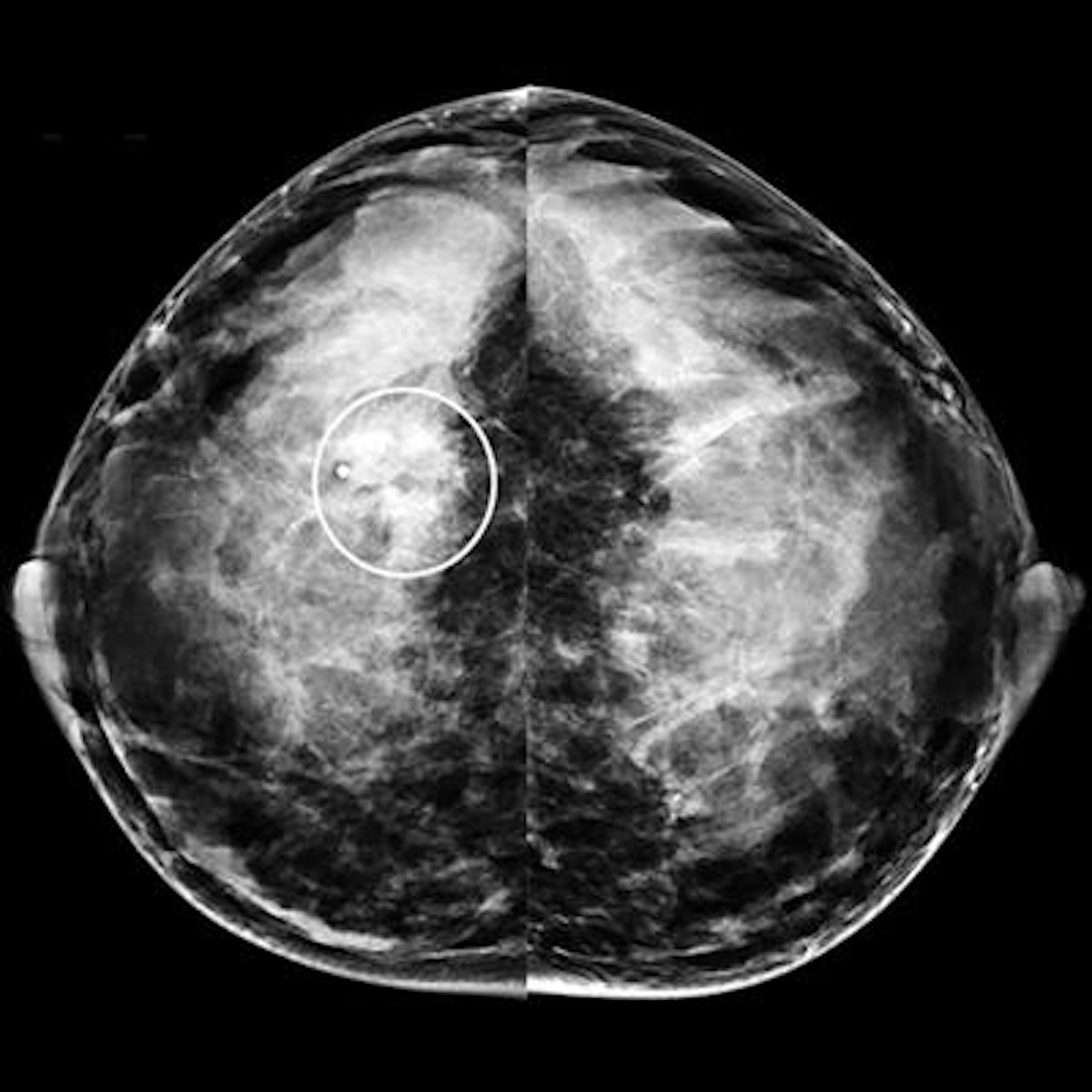 Ultrasound vs. mammo: What's best for lactating women? | AuntMinnie