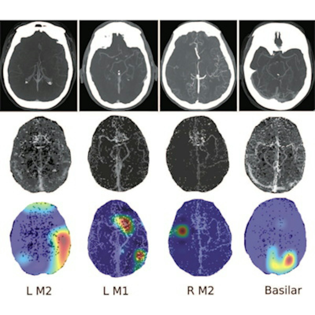 Algorithm detects LVO stroke on multiphase CTA | AuntMinnie