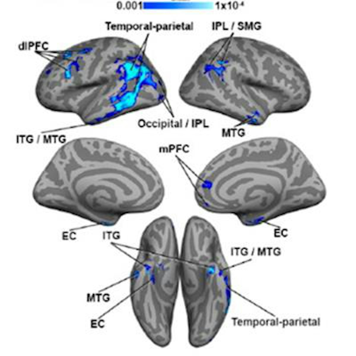 Impaired blood flow linked to tau buildup in AD patients | AuntMinnie