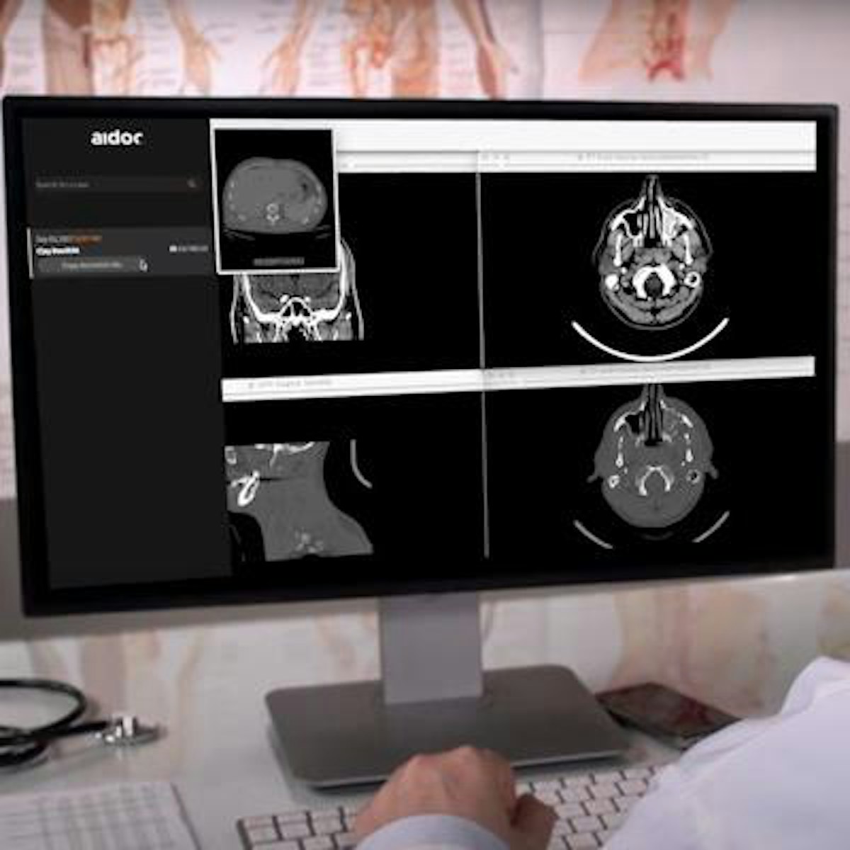 FDA clears Aidoc's incidental PE AI algorithm | AuntMinnie