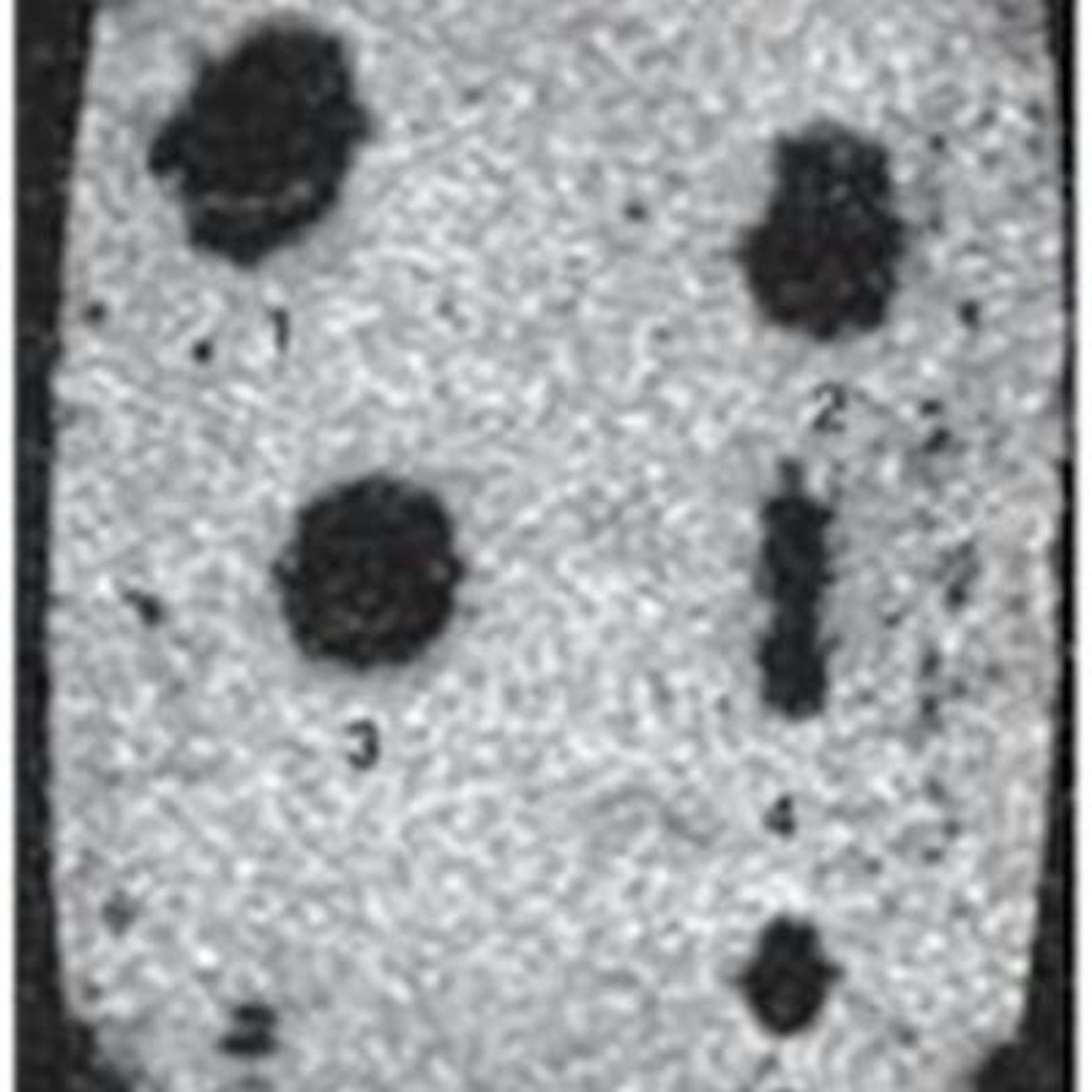 X-ray, CT resolve MRI bullet fragment safety | AuntMinnie