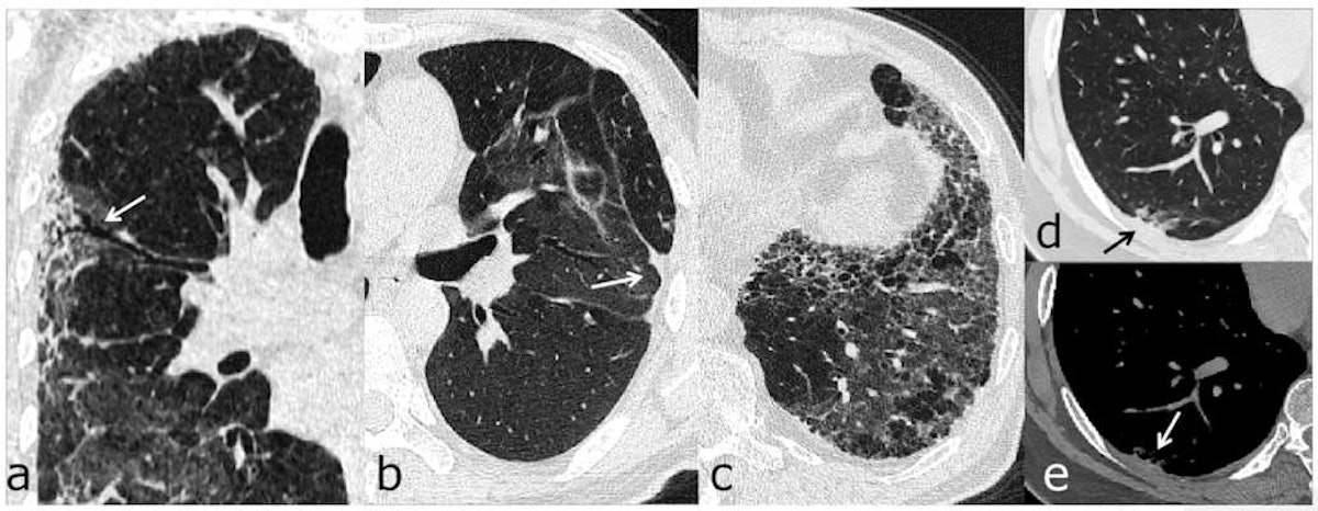 fibrotic changes lung