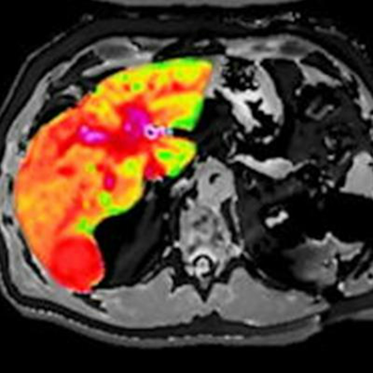 FDA clears Perspectum's liver cancer decision tool | AuntMinnie