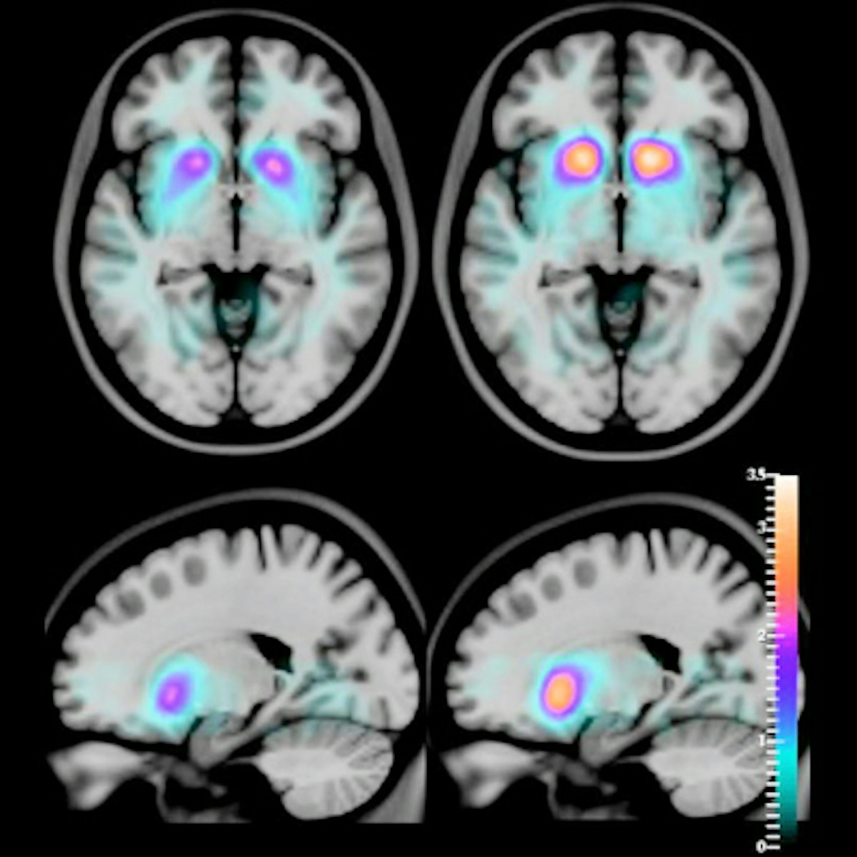 SPECT spots differences in dementia subtype, Alzheimer's | AuntMinnie