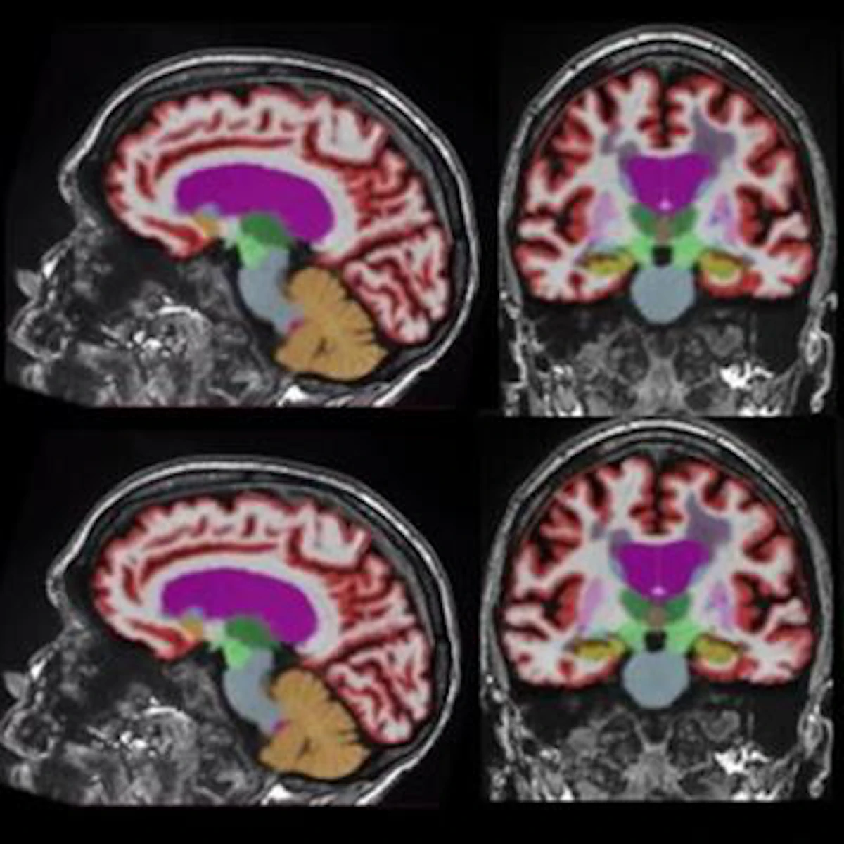 AI-based reconstruction speeds up quantitative volumetric MRI | AuntMinnie