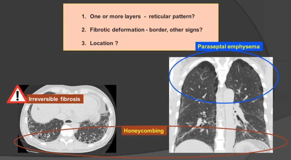 lung parenchyma