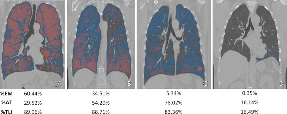 AI algorithm can predict severity, progression of COPD | AuntMinnie