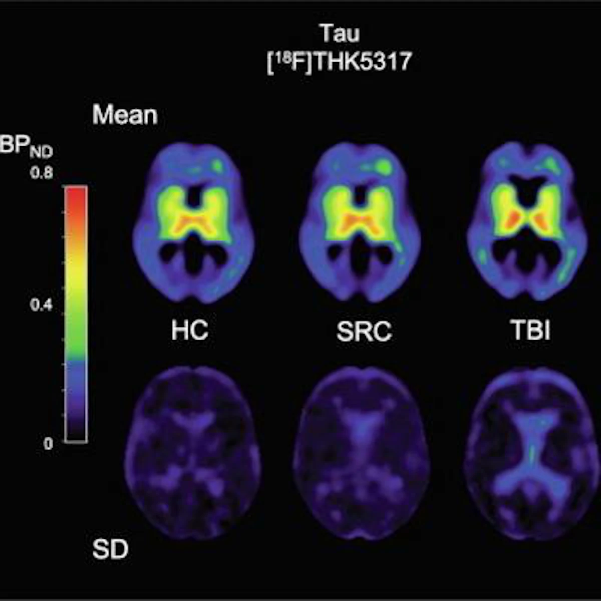 PET tracers reveal long-term consequences of brain injuries | AuntMinnie