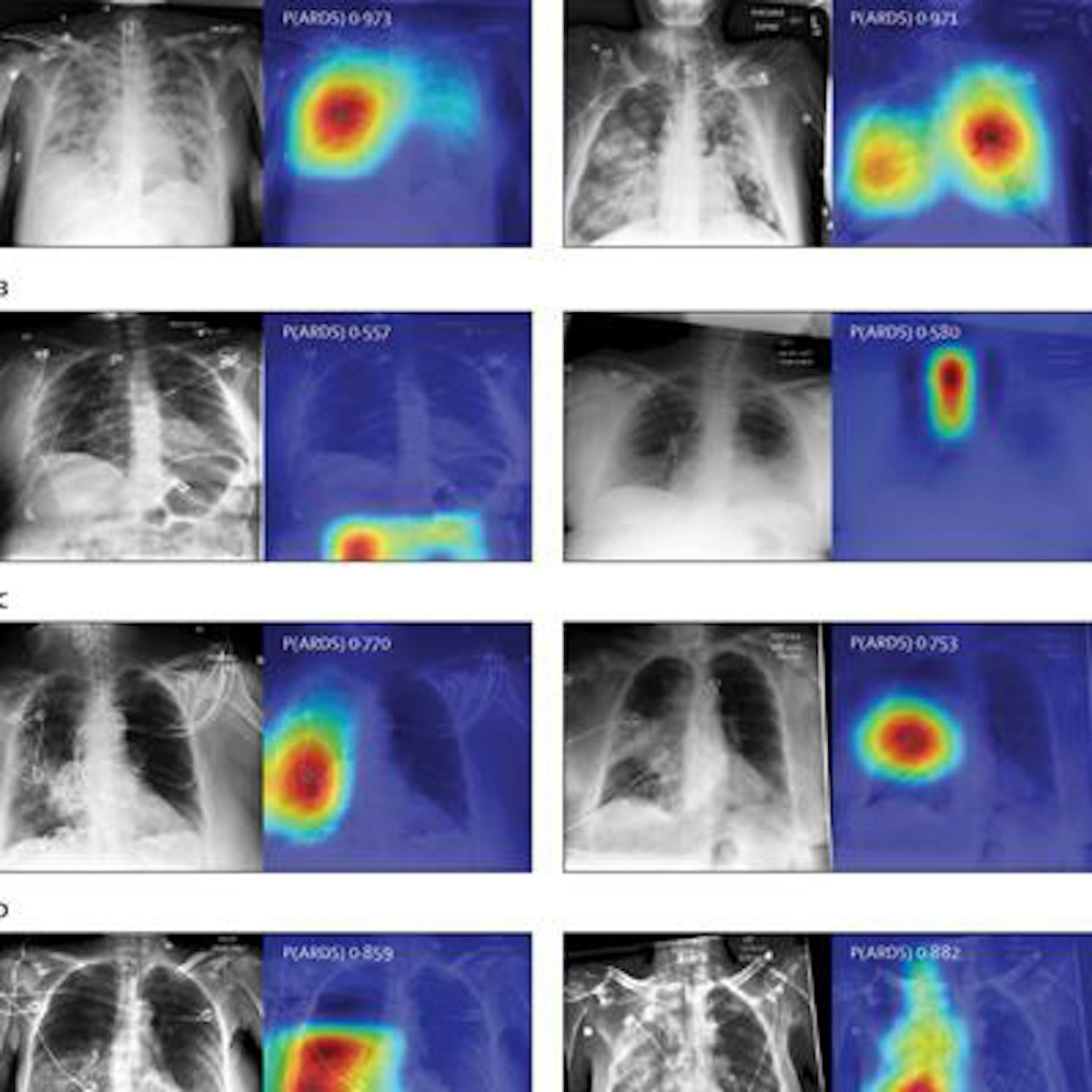 AI detects ARDS equal to experts | AuntMinnie