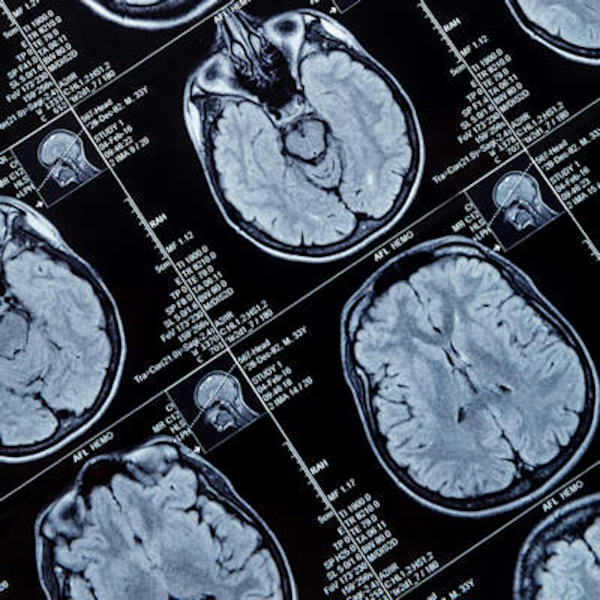 Bad hair day? Powdered hair products may pose problem for MRI | AuntMinnie