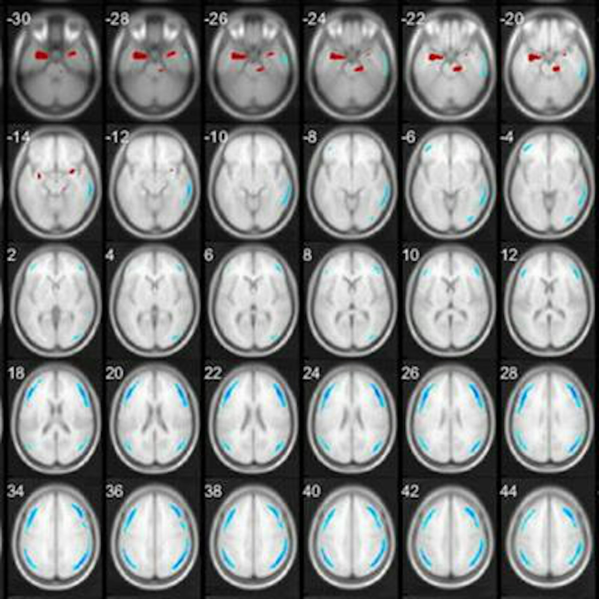 PET/CT detects major depression in cancer patients | AuntMinnie