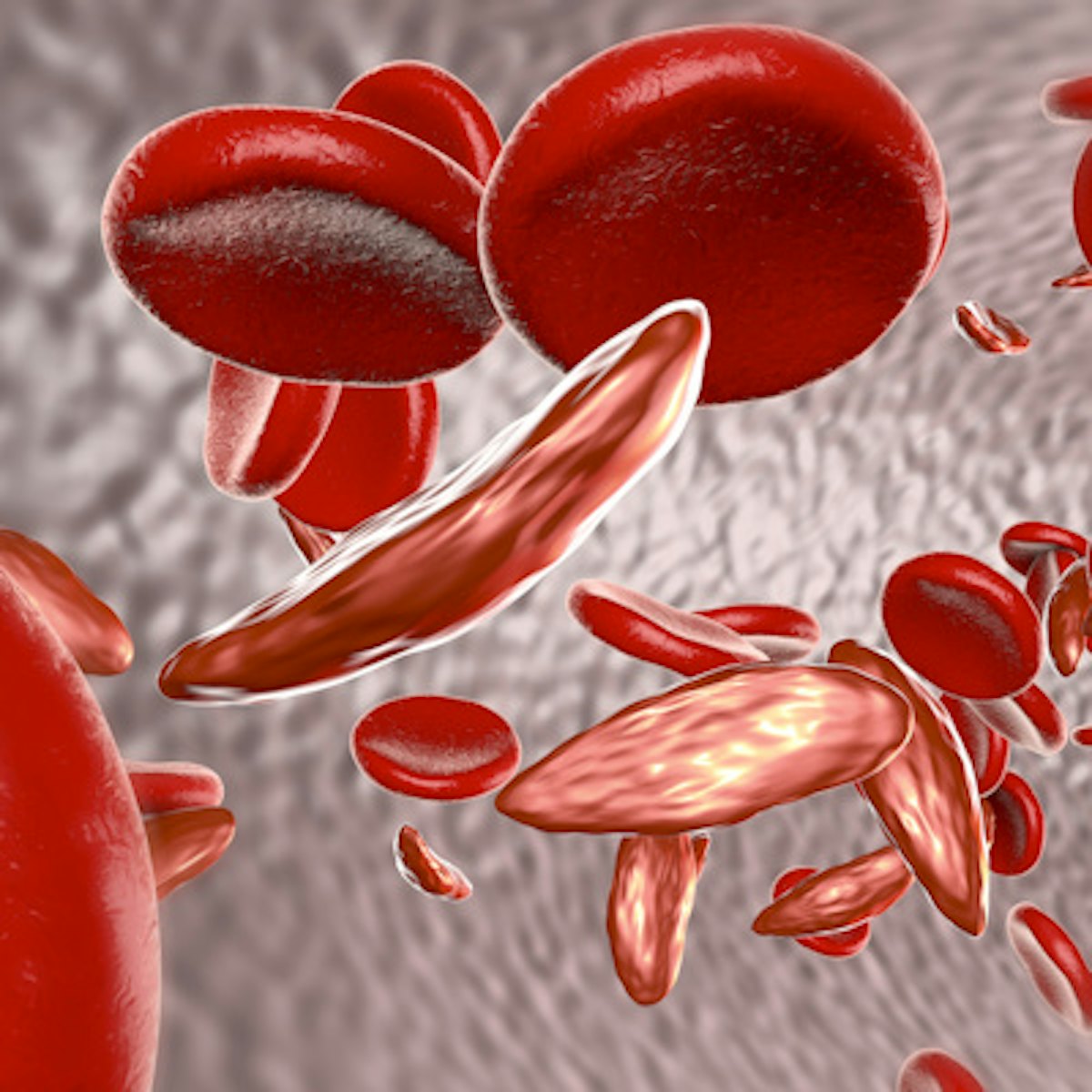 7T MRI visualizes sickle cell disease's effect on the brain | AuntMinnie