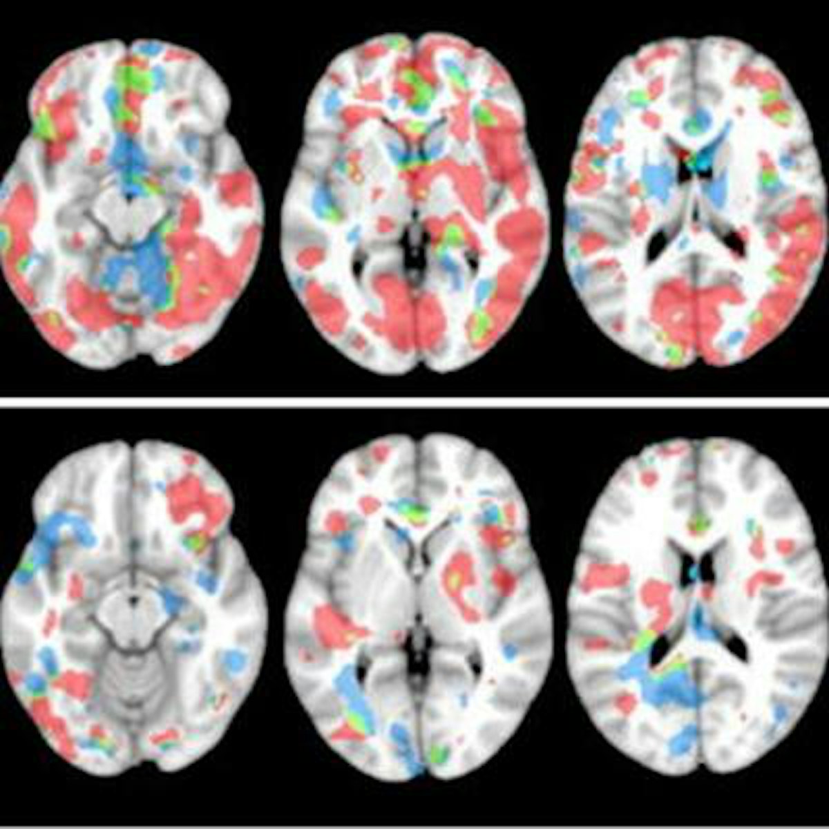 MRI shows how head impacts affect brains of young football players ...