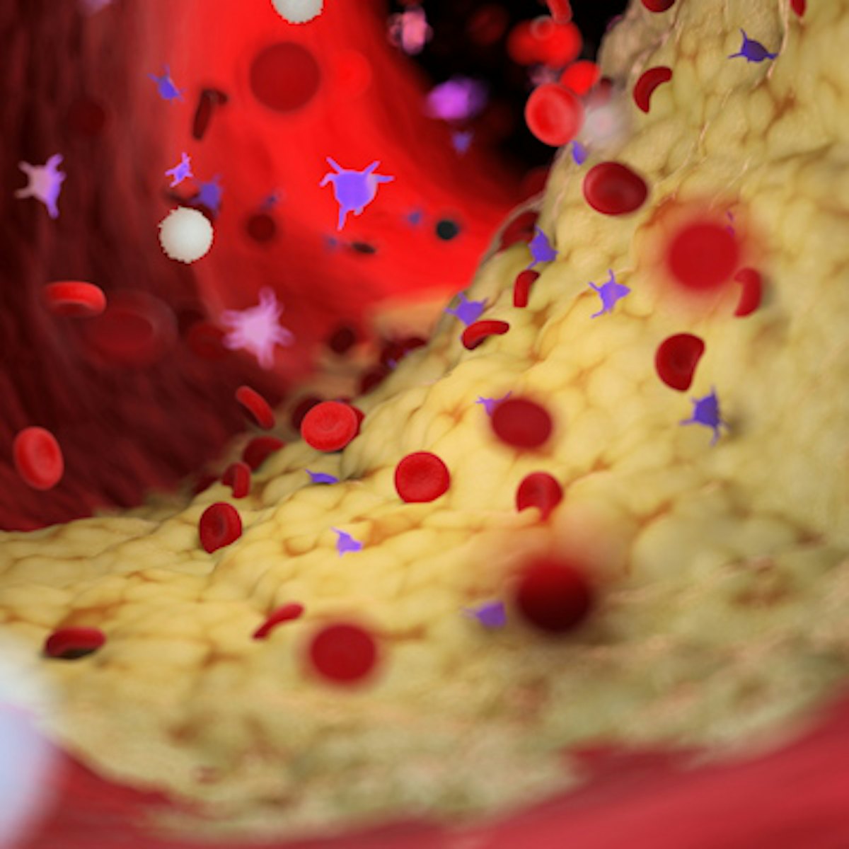 CTA shows how statin treatment changes coronary plaque | AuntMinnie