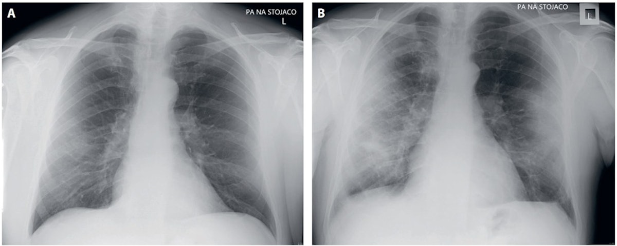 chest x ray changes