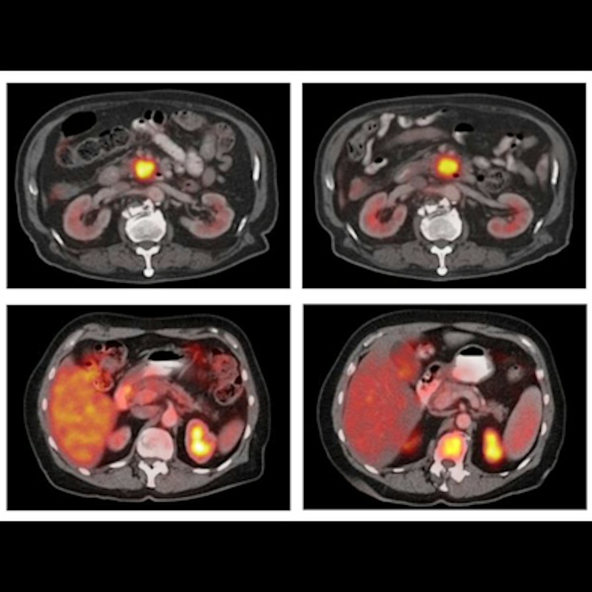 PET/CT predicts survival in pancreatic cancer patients | AuntMinnie