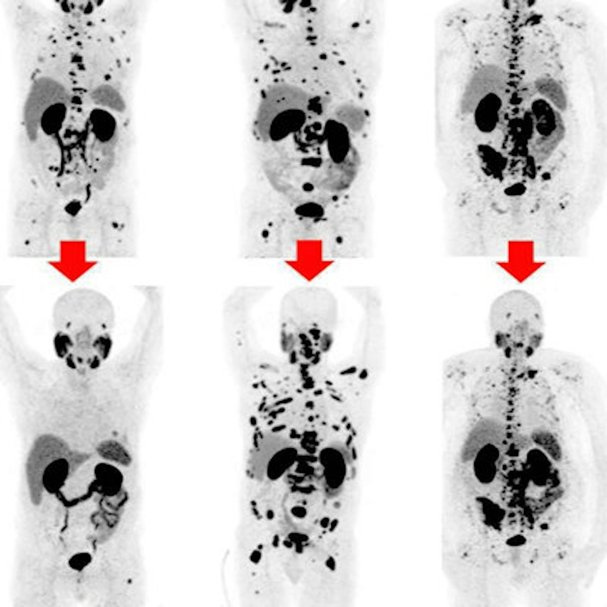PSMA-PET predicts patient response to chemotherapy | AuntMinnie