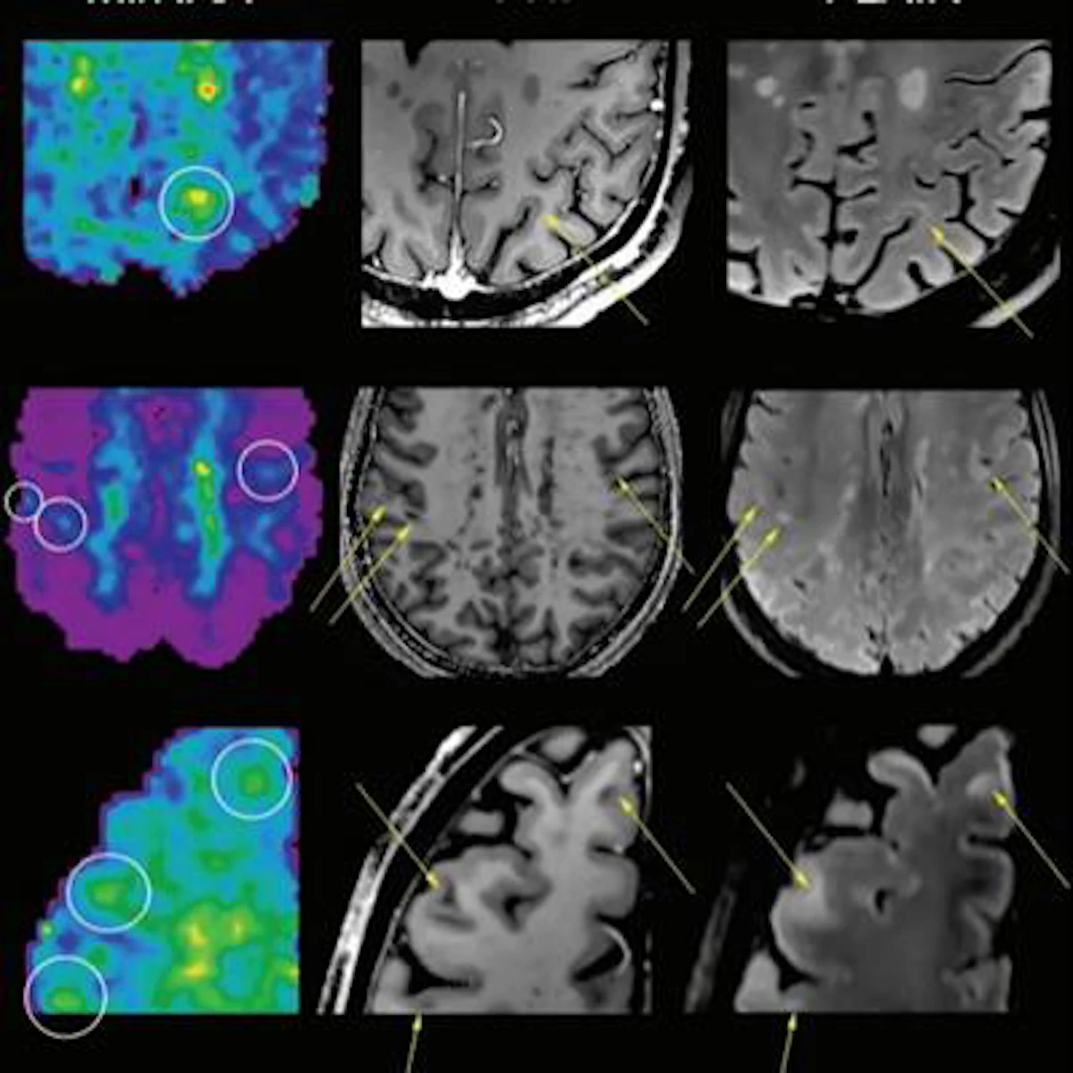 7T proton MR spectroscopy spots brain changes in MS patients | AuntMinnie