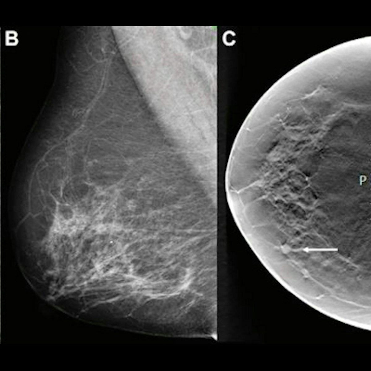 Can AI and radiologists work in harmony for double reading? | AuntMinnie