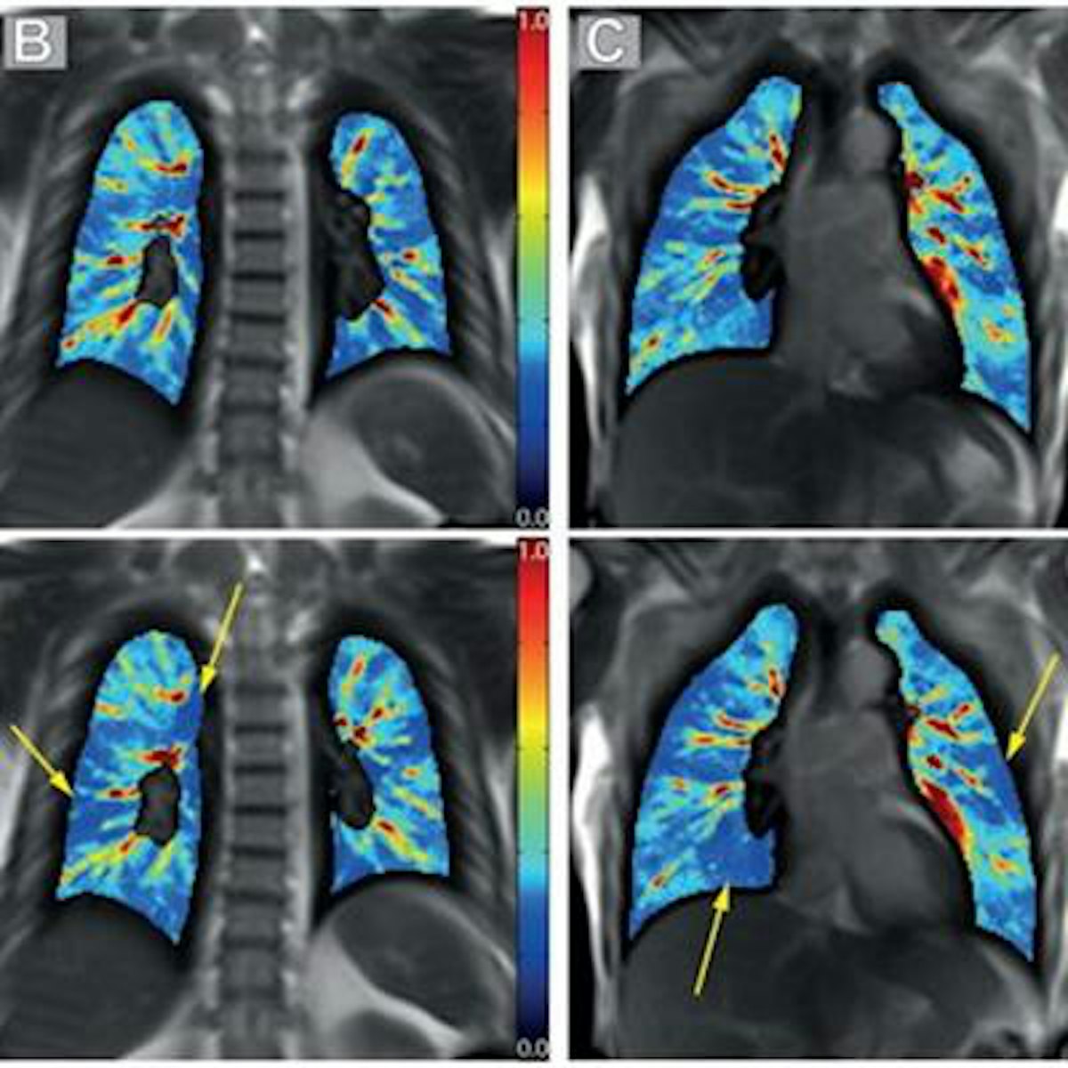 MRI offers noninvasive way to assess effects of vaping, smoking ...