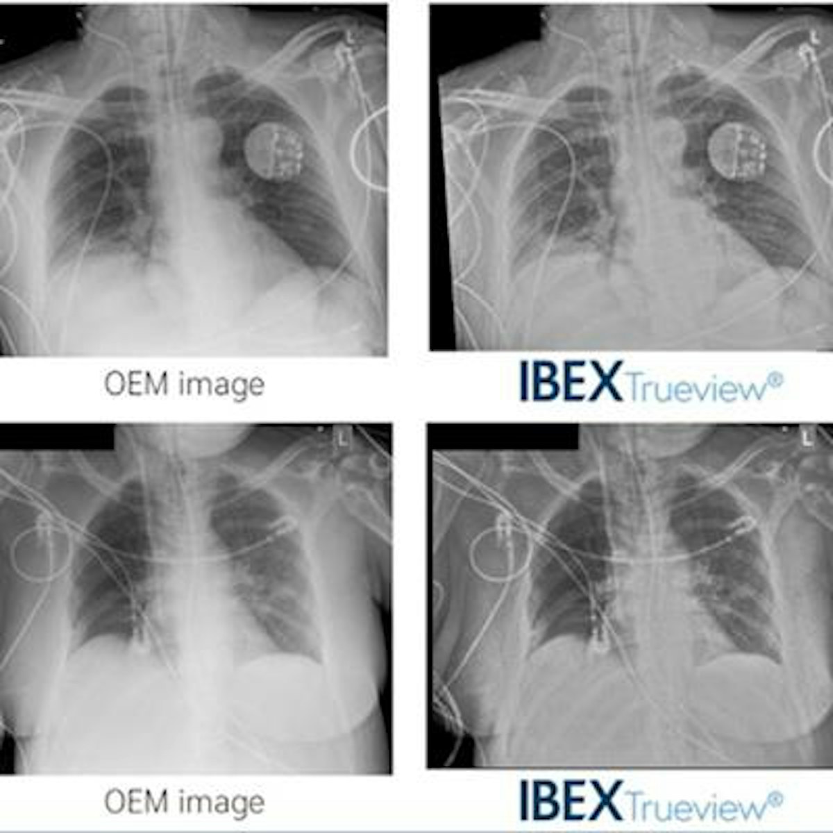 Ibex promotes study of AI software to assess tube and line placement ...