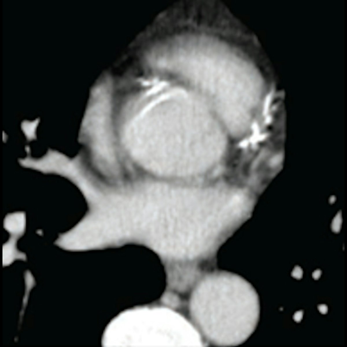 Visual CAC assessment on CT exams compares well with cardiac CT results ...