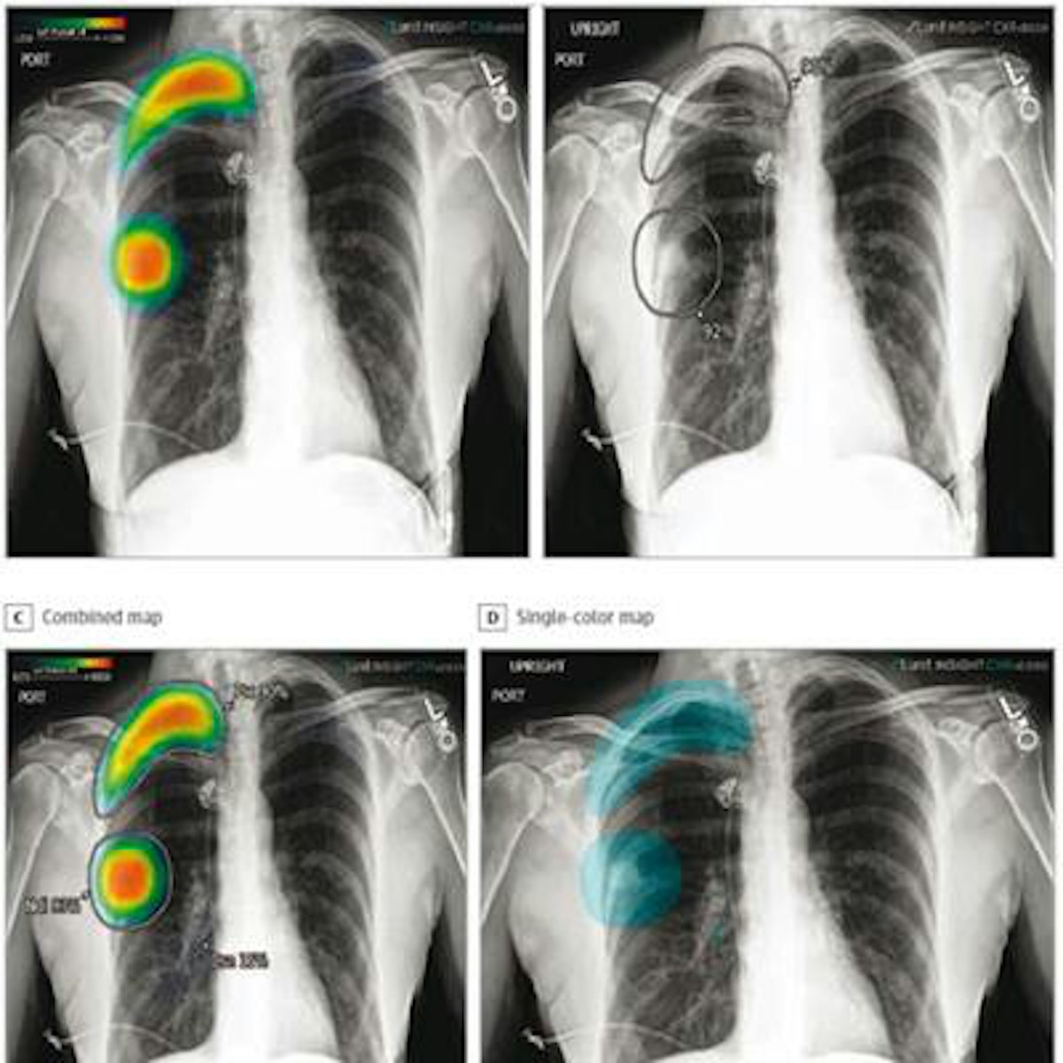 AI improves chest x-ray interpretation in real-world study | AuntMinnie