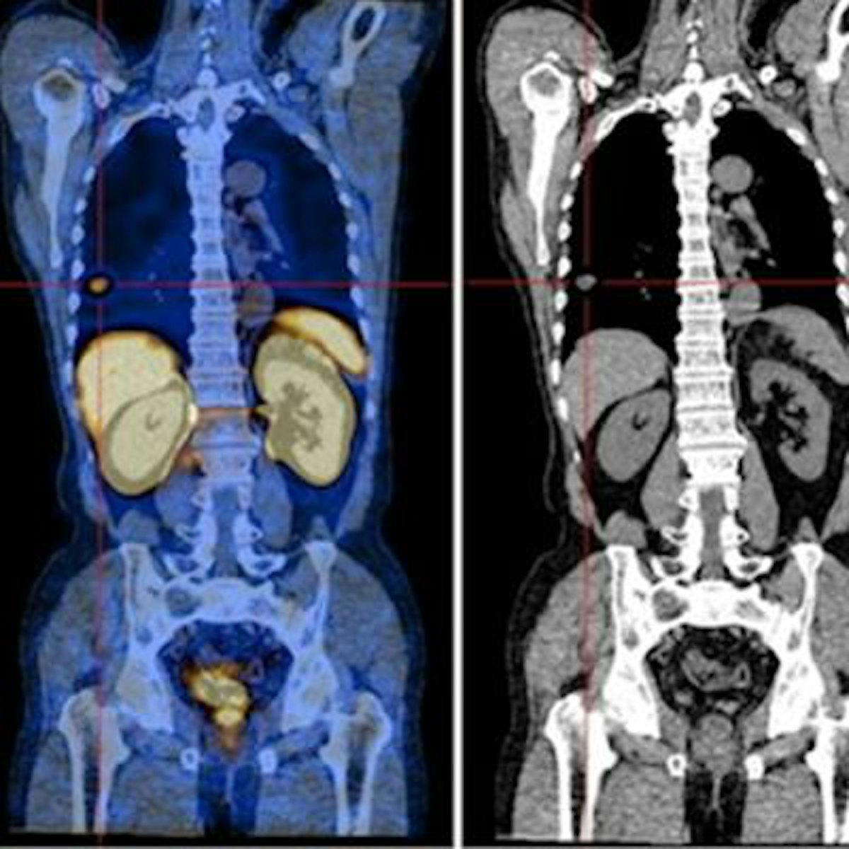 SPECT tracers go head-to-head in prostate cancer patients | AuntMinnie