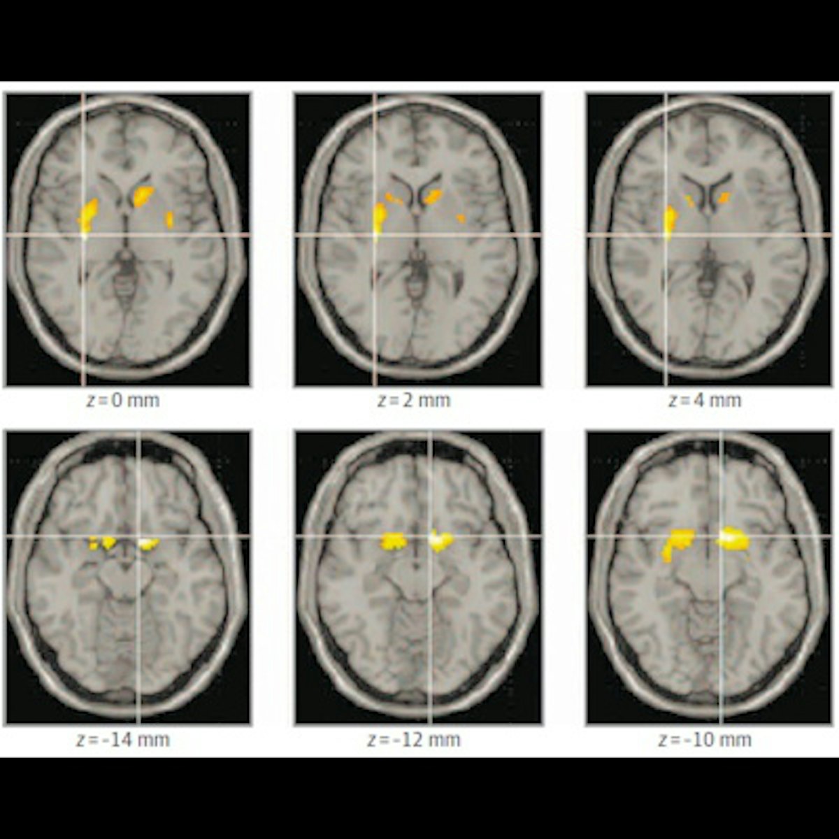 PET reveals the nature of brain activity in bipolar disorder | AuntMinnie