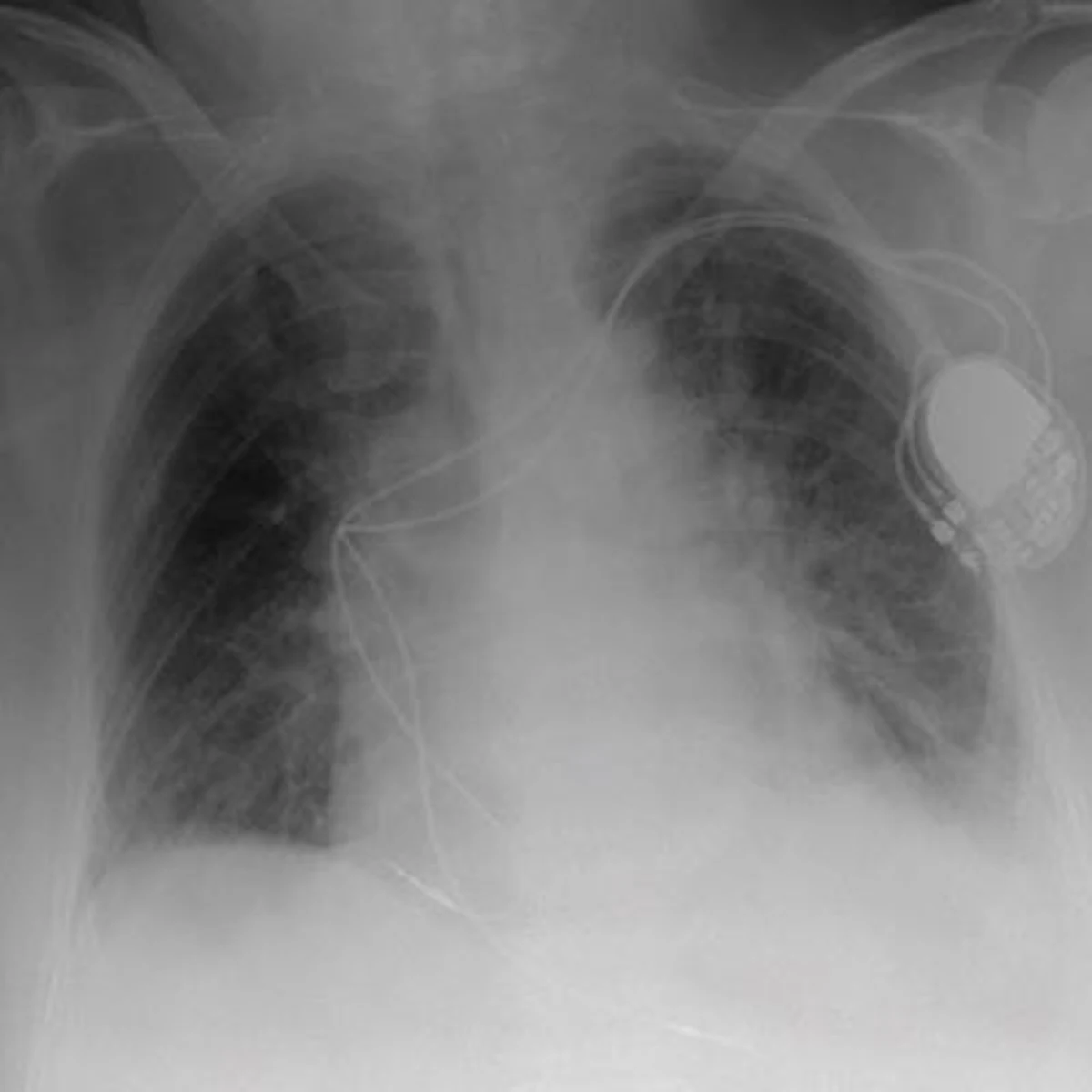 AI chest x-ray algorithm shows promise for emergency department reads ...