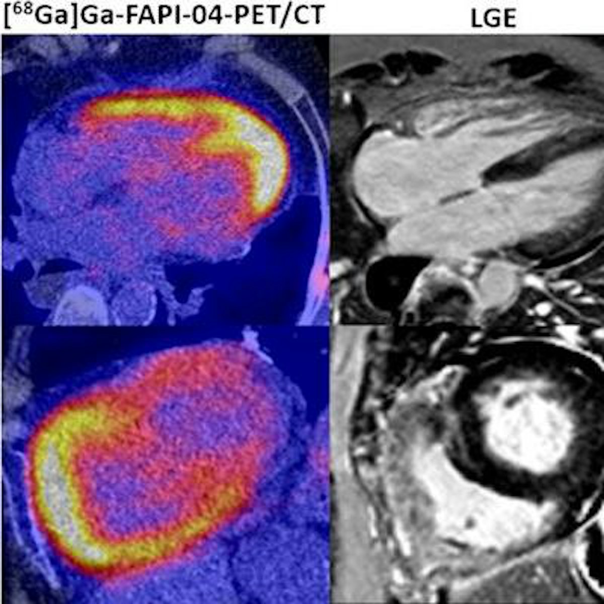 FAPI-PET visualizes myocardial fibrosis on molecular level | AuntMinnie