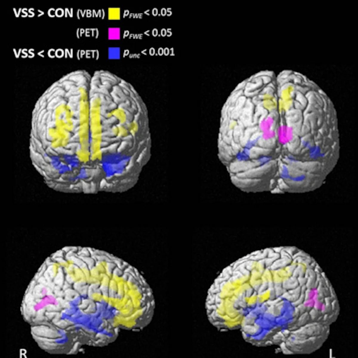 Brain PET/MRI scans reveal visual snow syndrome | AuntMinnie