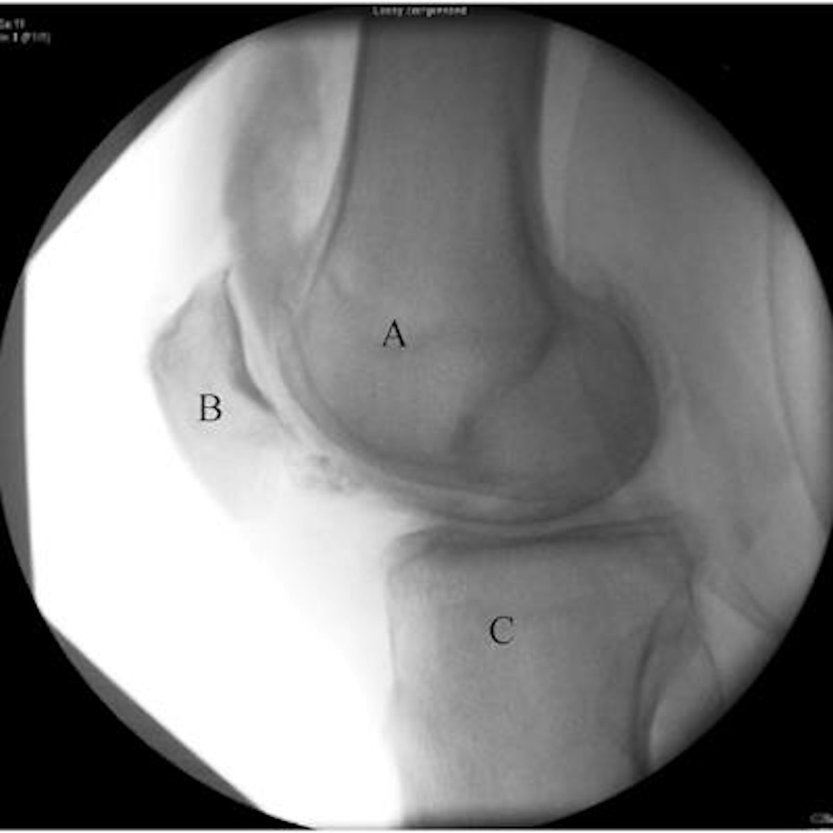 Fluoroscopy confirms accuracy of knee injections | AuntMinnie