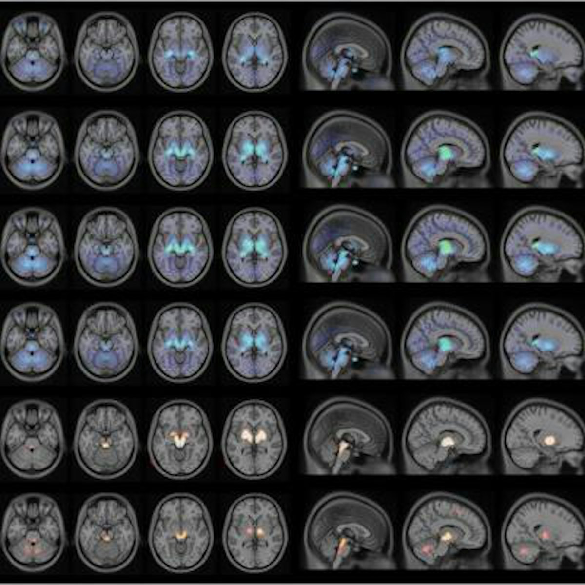 New PET radiotracer shows promise for rare brain disorder diagnosis ...
