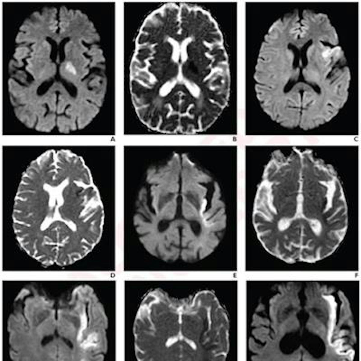 Stroke indicator found on MRI could help with treatment strategies ...