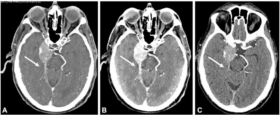 PCCT allows radiologists to 'see more with less' | AuntMinnie