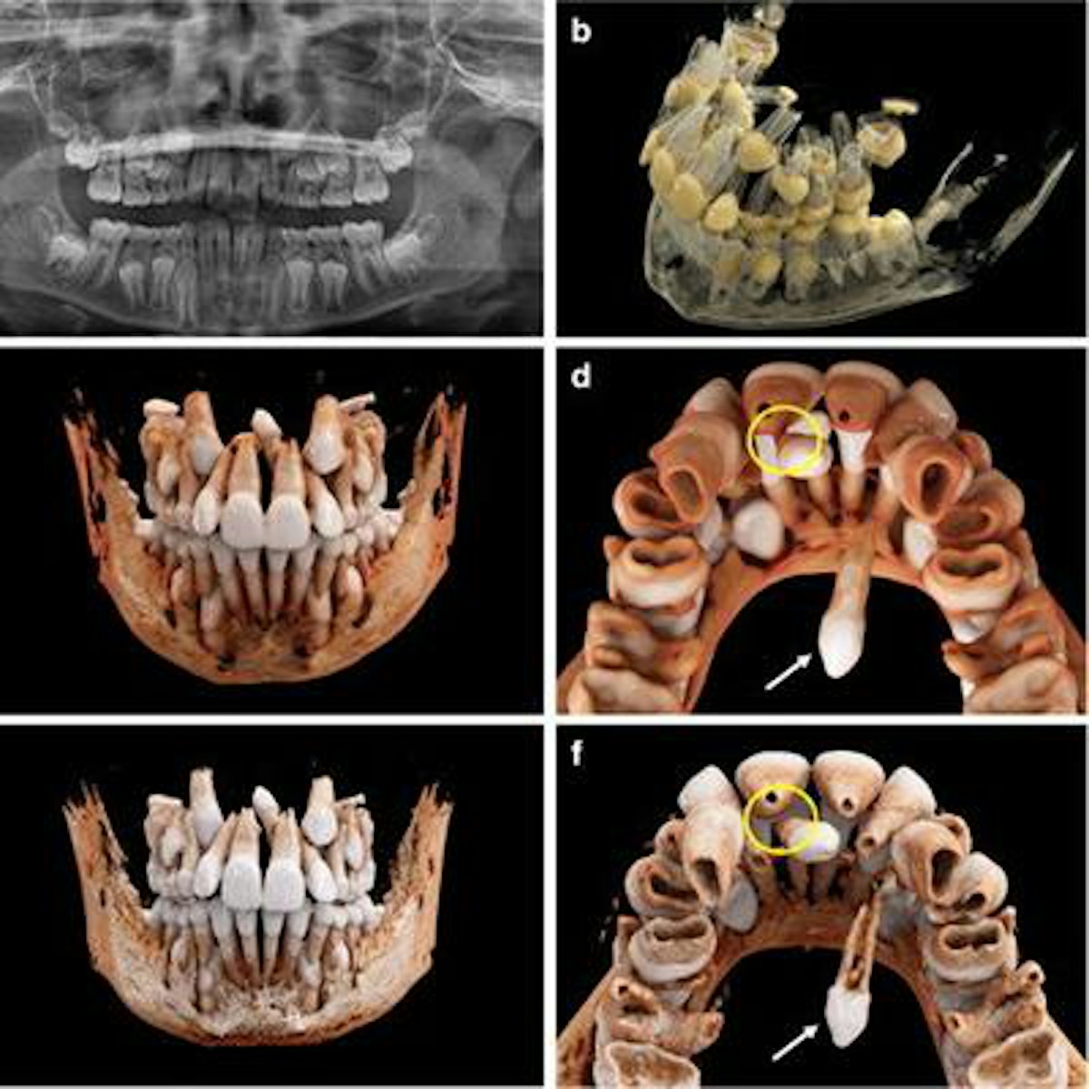 Modified imaging technique visualizes teeth segmented from bone ...