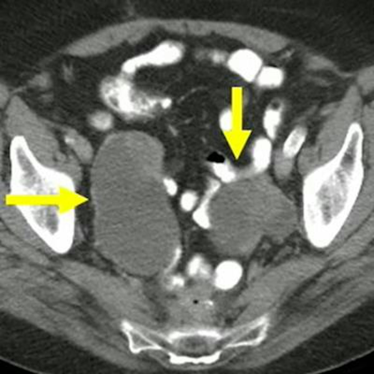 TVUS-guided transvaginal biopsy safe, effective for pelvic lesions ...