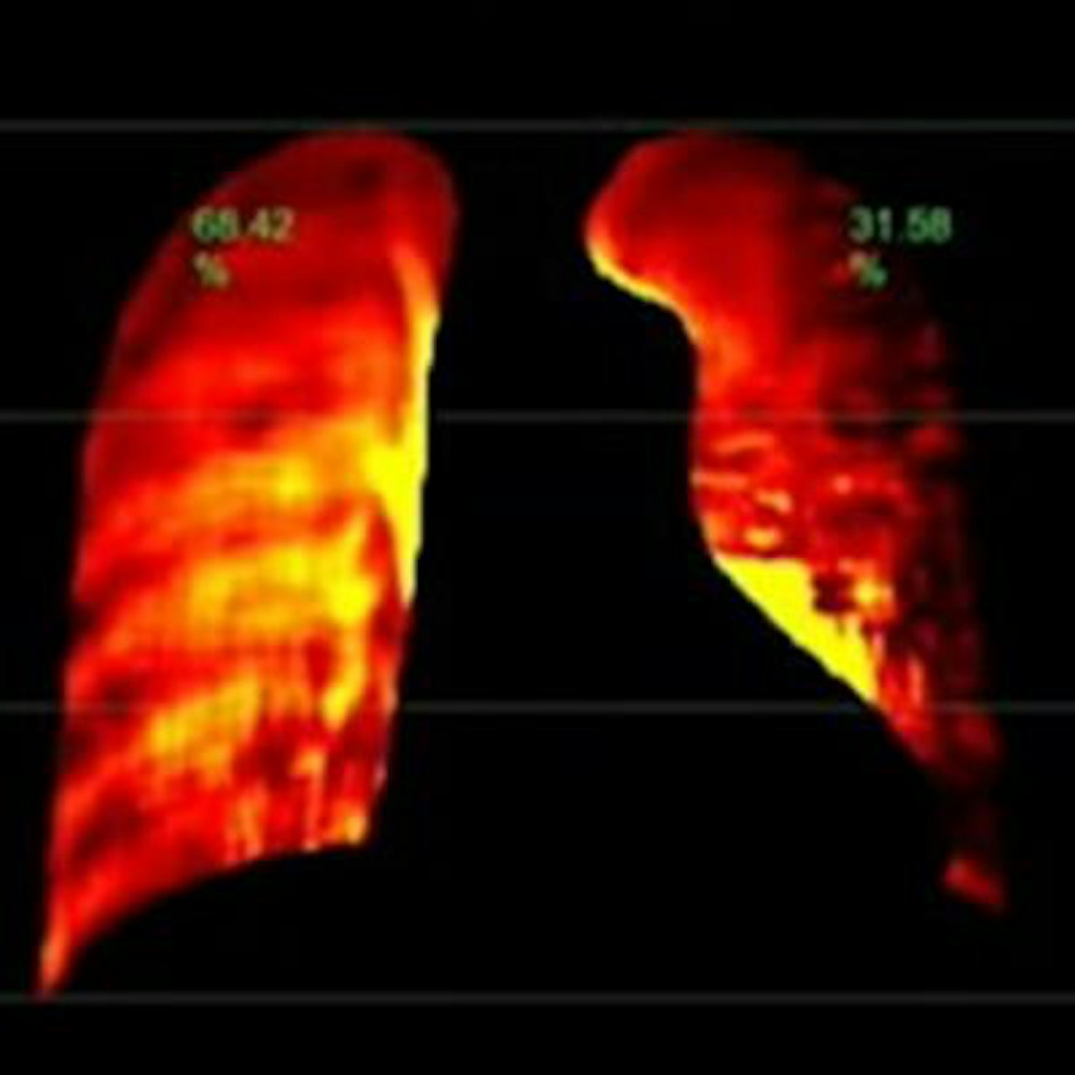 Dynamic digital radiography tested in lung transplant patients | AuntMinnie