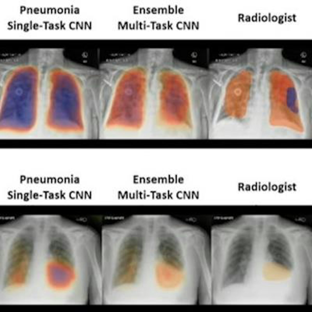 AI model can differentiate pneumonia and pulmonary edema | AuntMinnie