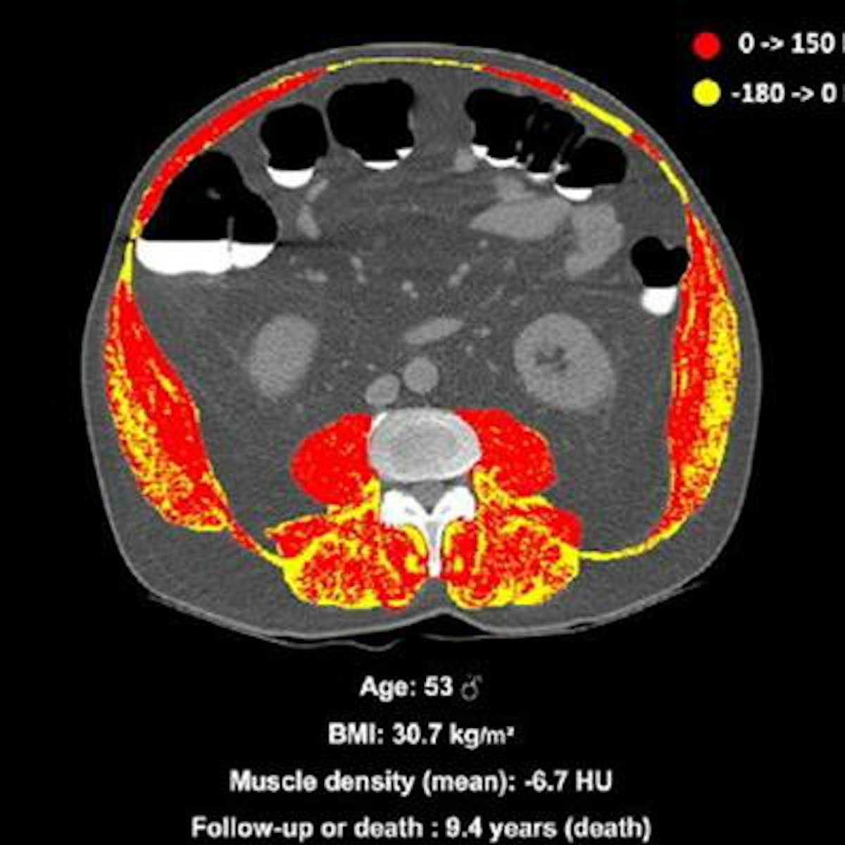 CT body composition assessment links muscle fat and mortality risk ...