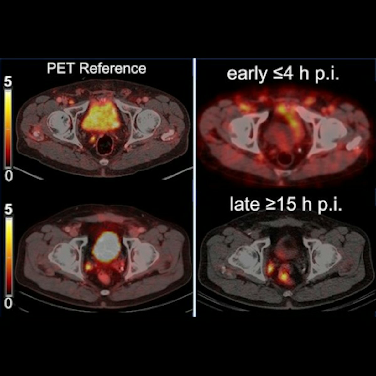 Delayed SPECT improves prostate cancer detection | AuntMinnie
