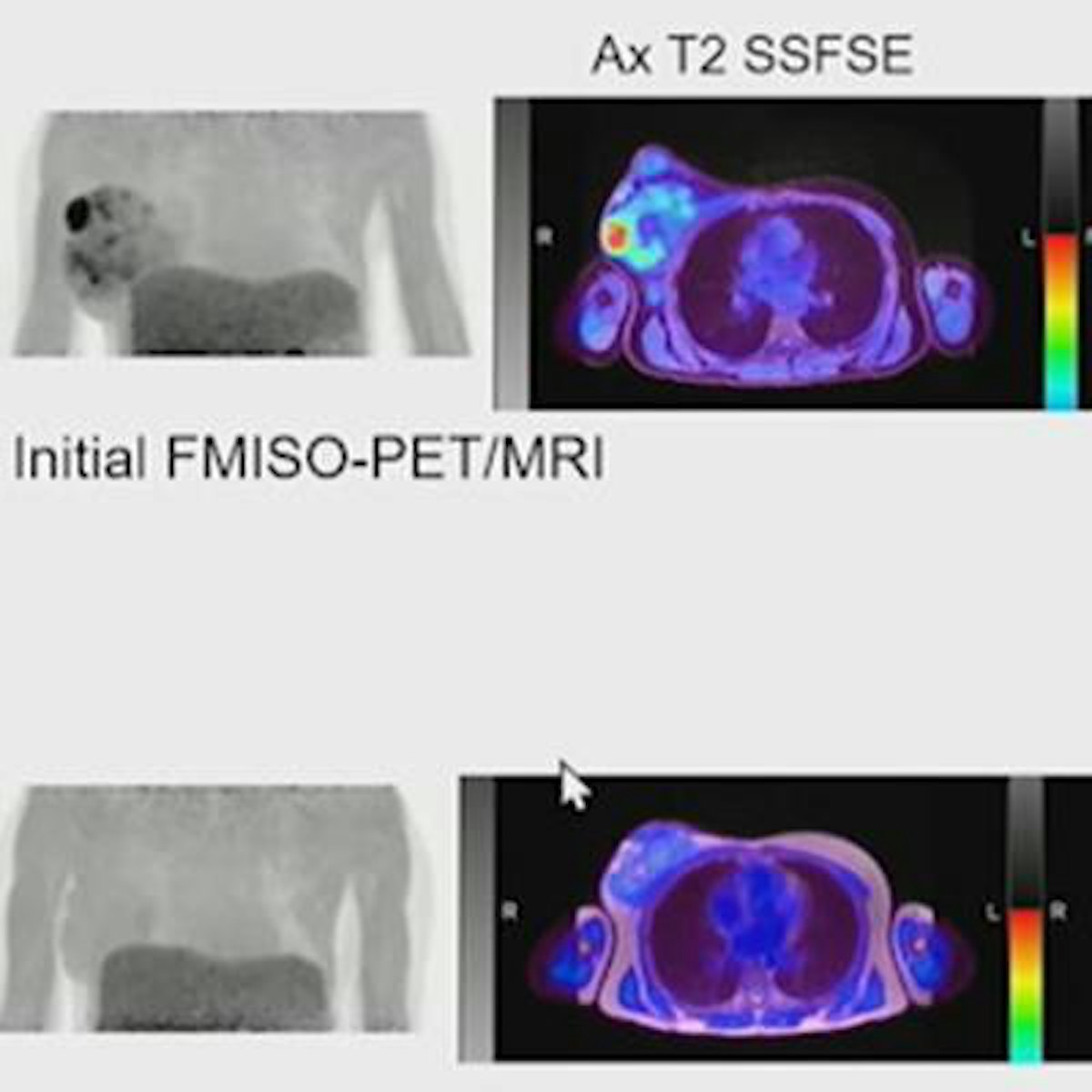 PET/MRI shows promise for breast cancer imaging | AuntMinnie