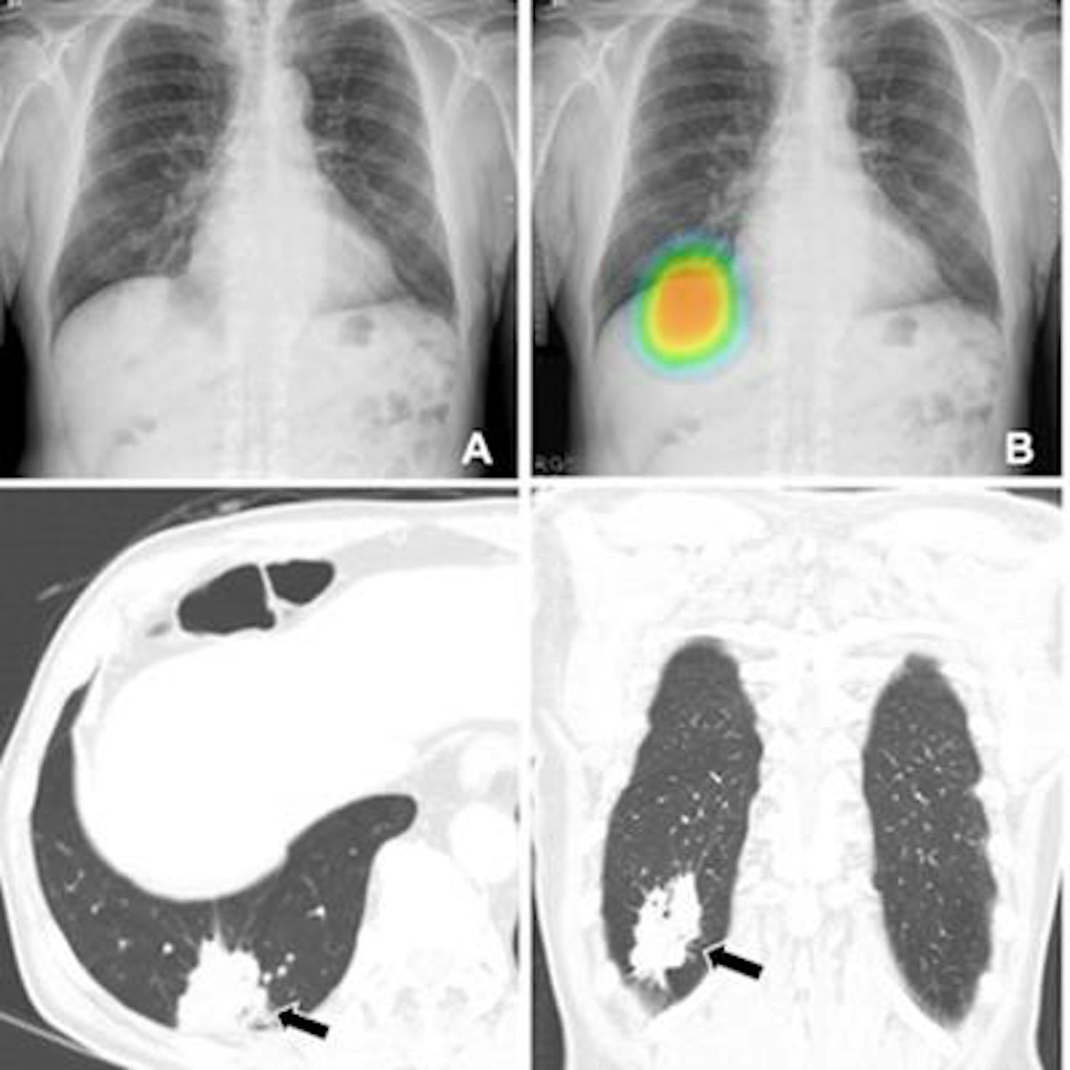 AI improves lung cancer detection on chest radiographs | AuntMinnie