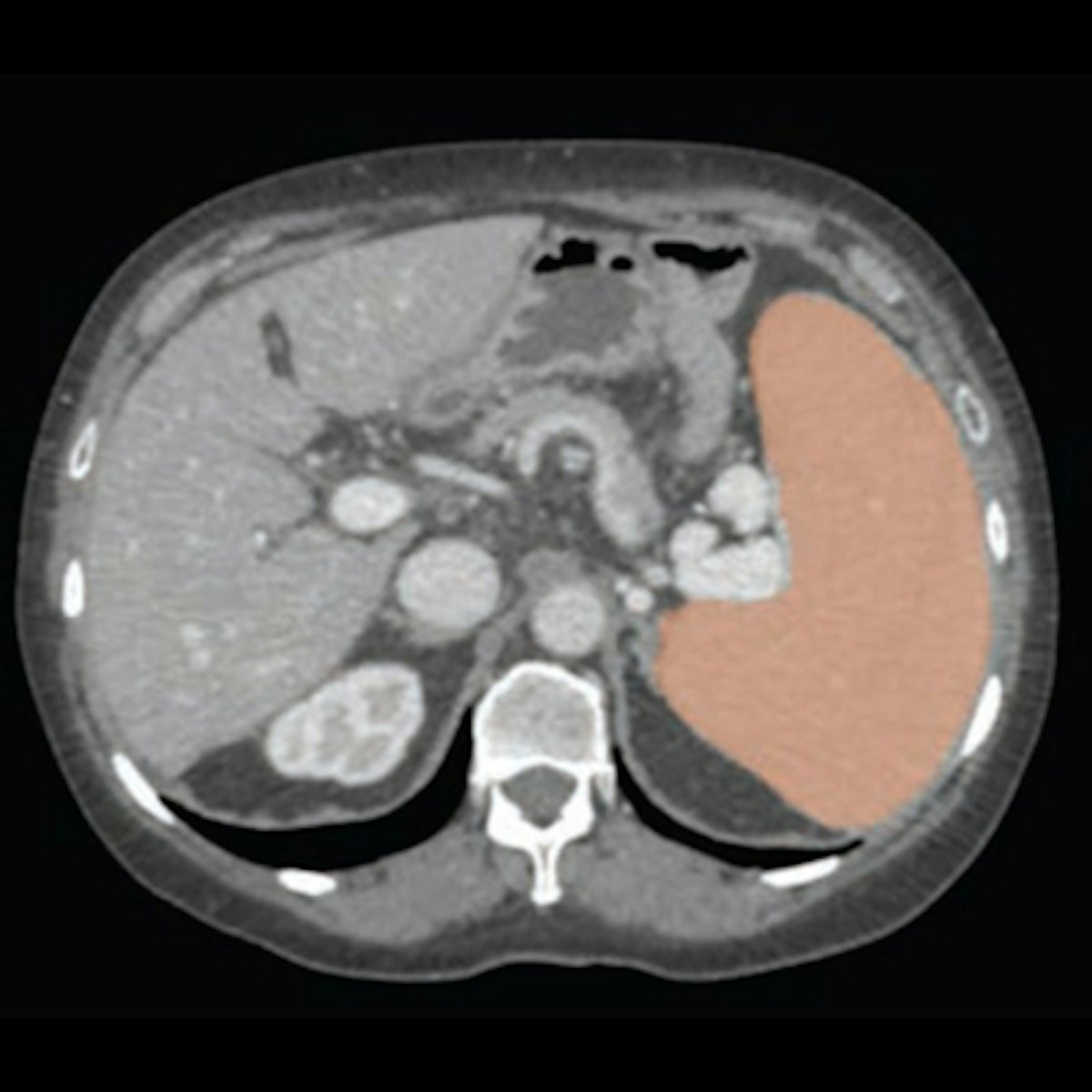 AI and CT facilitate opportunistic screening for enlarged spleen ...