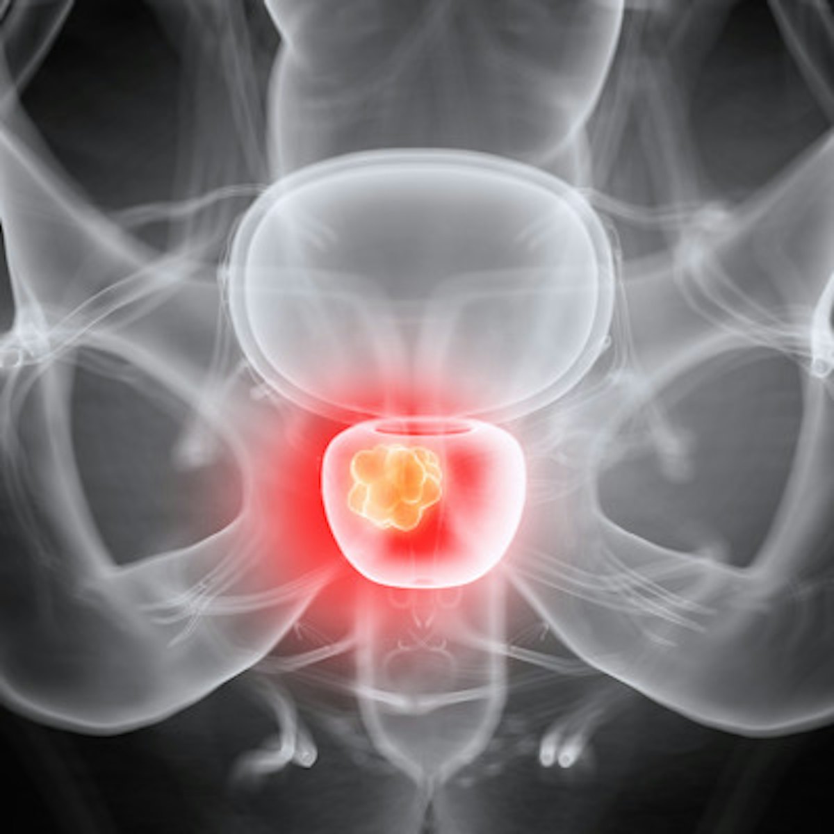 NCCN adds Blue Earth's Posluma to its oncology guidelines | AuntMinnie