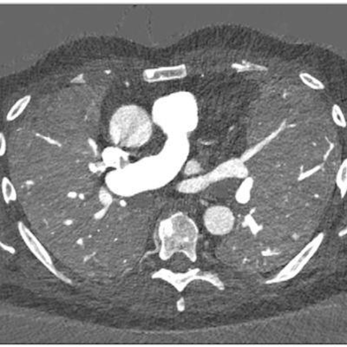 PCCT bests standard CT for evaluating lung structure and function ...