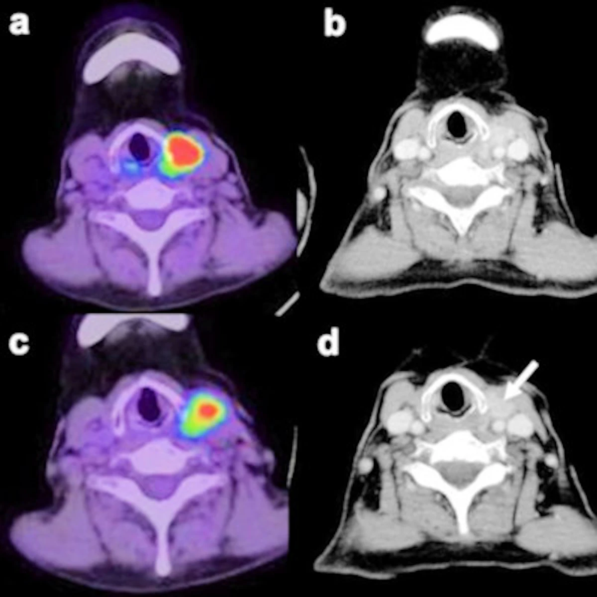 PET/CT scans predict outcomes in patients with thyroid cancer | AuntMinnie