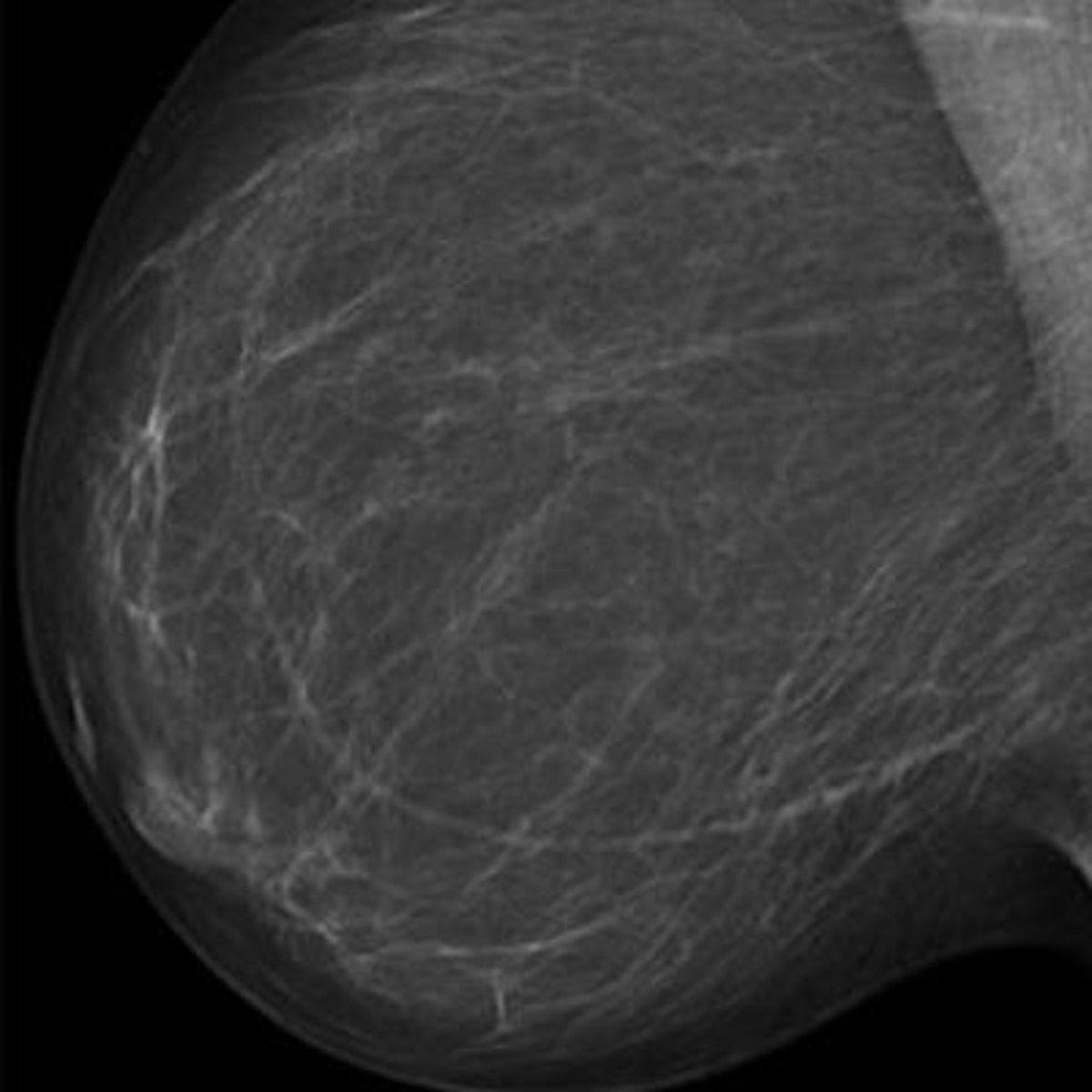 Combined AI mammo texture model improves cancer risk assessment ...