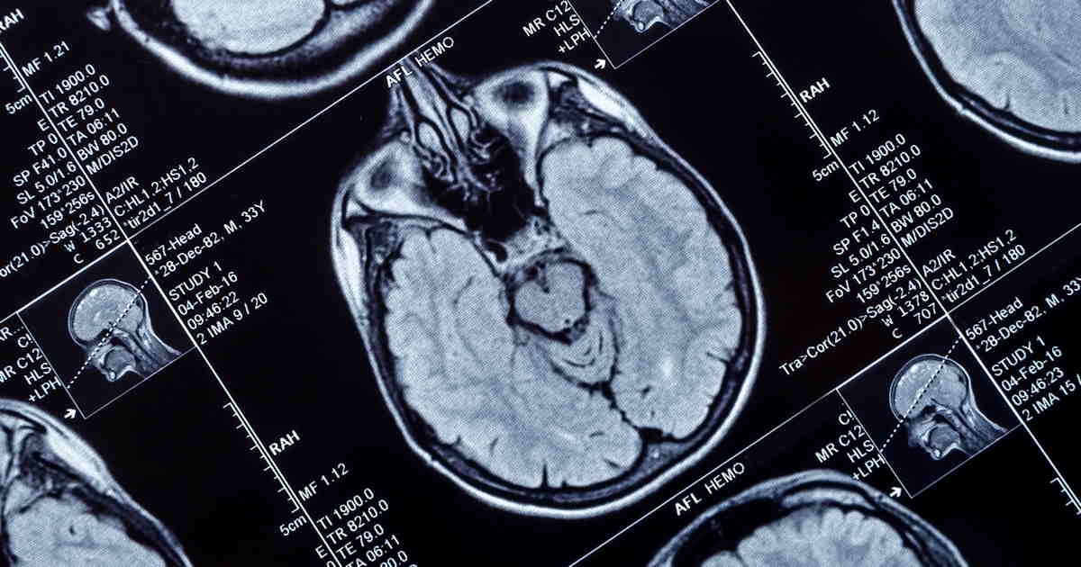 Researcher receives grant to study brain imaging data | AuntMinnie